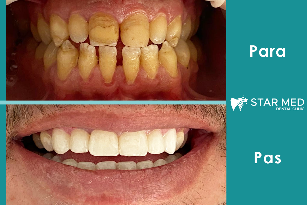 Punim i kryer me Faseta E-Max - Starmed Dental Clinic